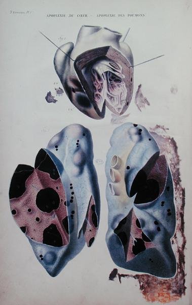 Apoplexy of the heart and of the lungs, illustration plate from ...