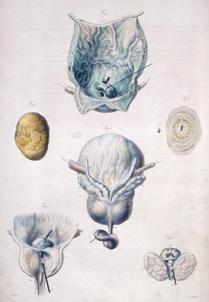 Diseases of the bladder and prostate, from 'Anatomie Pathologique du ...