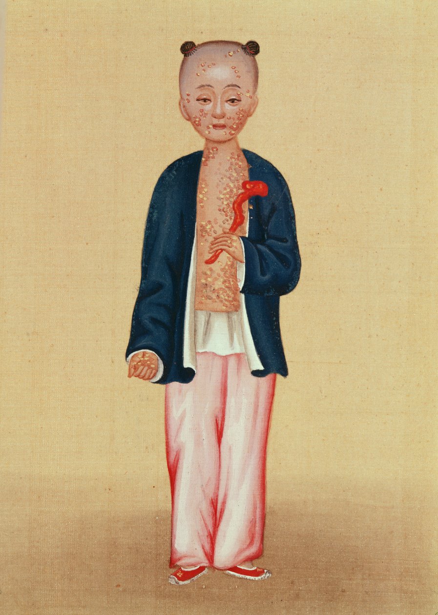 Child with smallpox by Chinese School: Buy fine art print