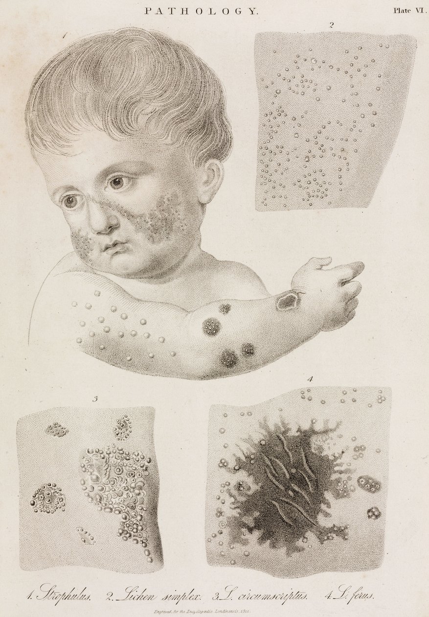 Types of Skin Disease by John Pardon: Buy fine art print
