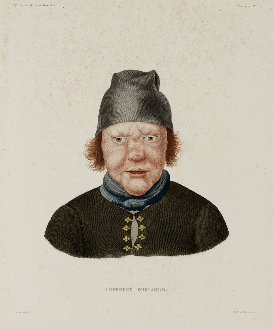 Diseases, Leprosy Female Leper, Iceland, early 19th century